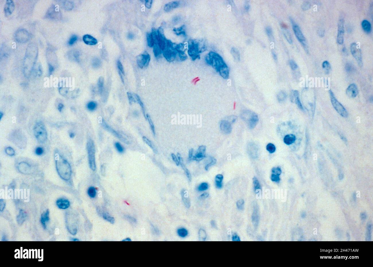 Tuberculous lymphadenitis hi-res stock photography and images - Alamy