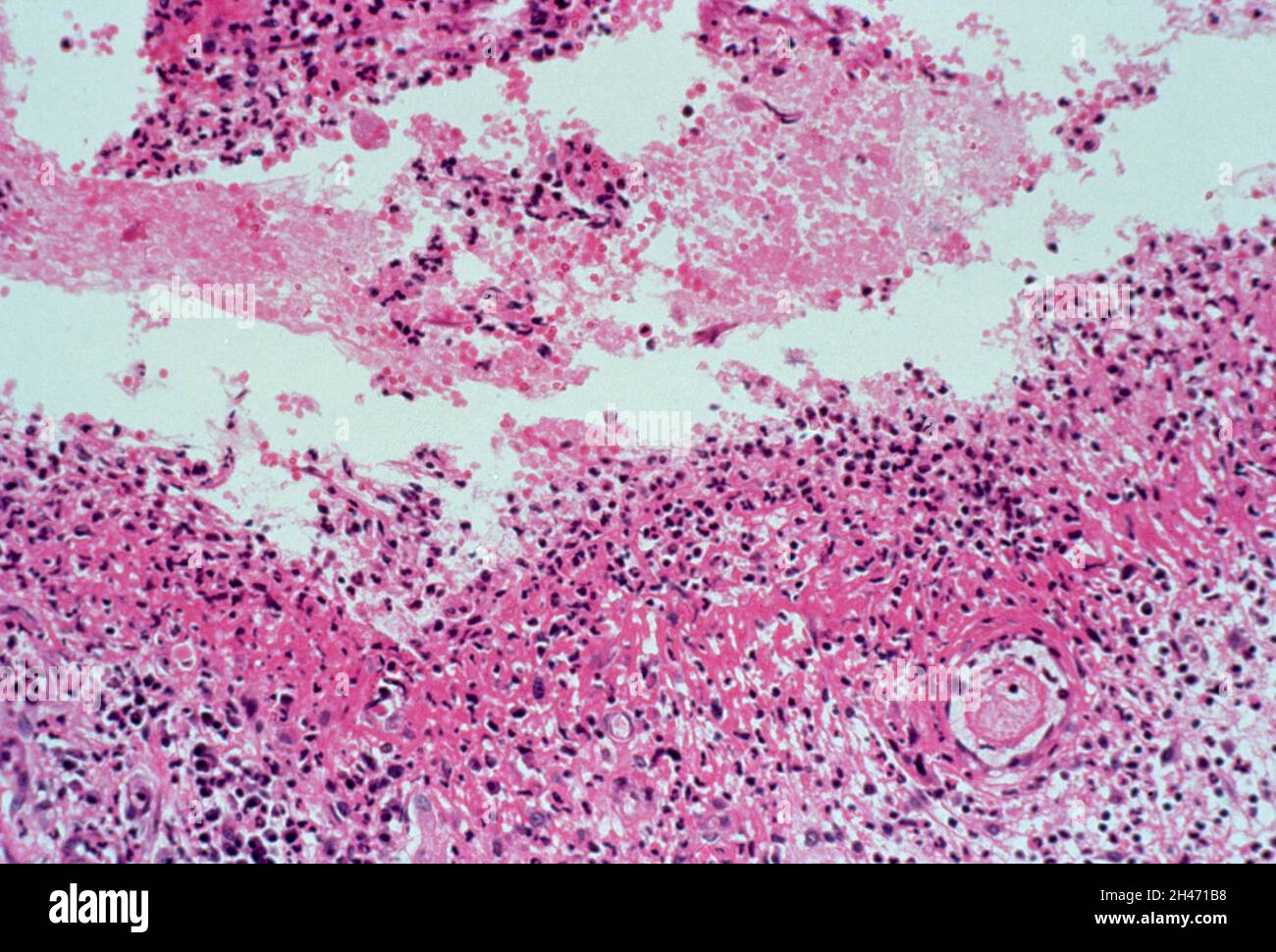 Skin: cutaneous amoebiasis Stock Photo - Alamy