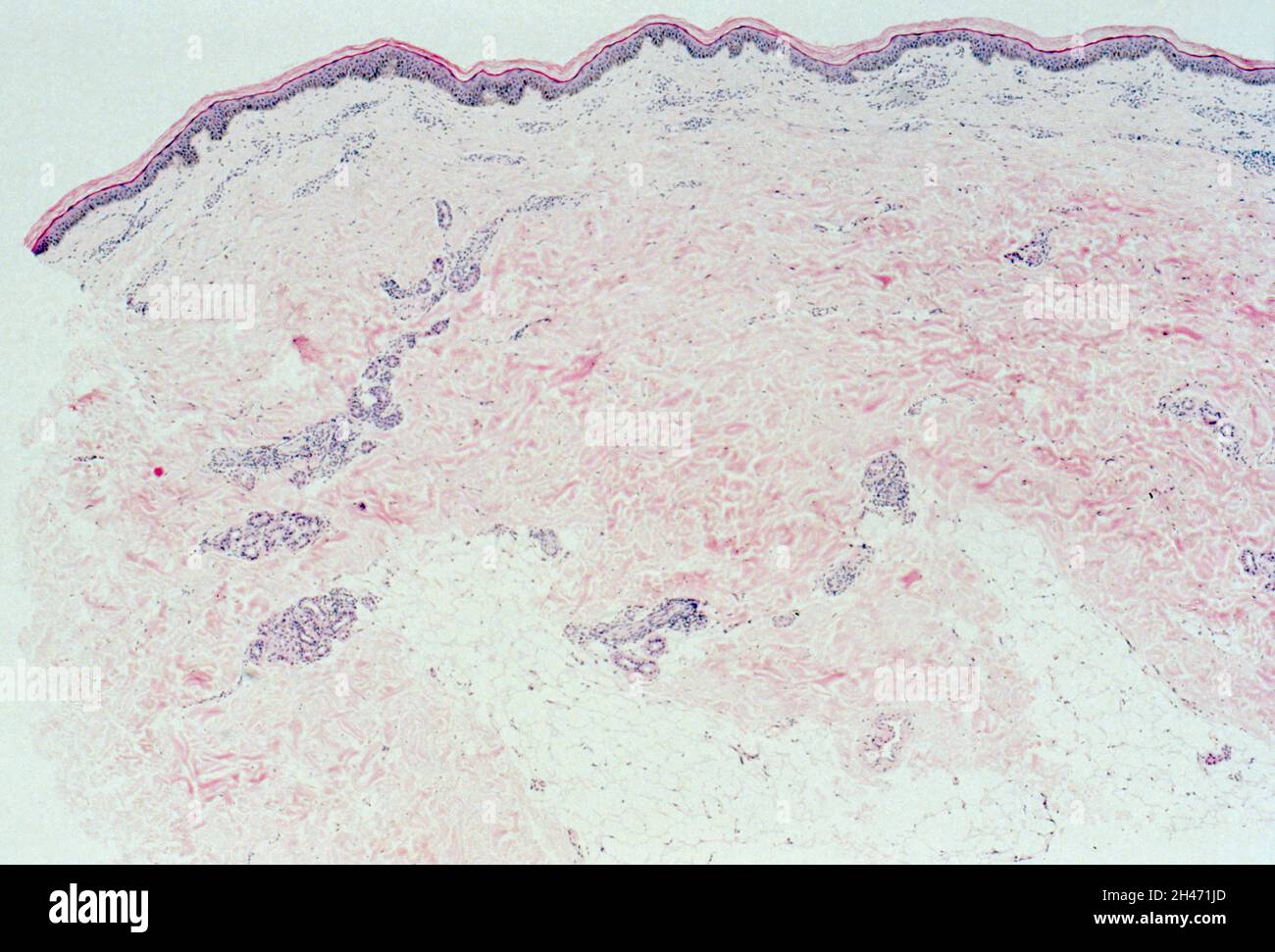 Chronic bacterial skin disease hi-res stock photography and images - Alamy