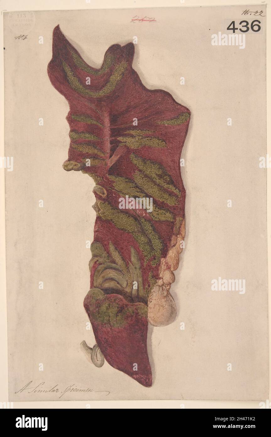 Sloughing of the mucous membrane in the colon in enteric fever Stock ...