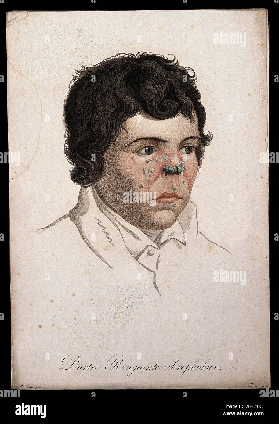 Head of a man with a skin disease on his nose. Coloured stipple ...