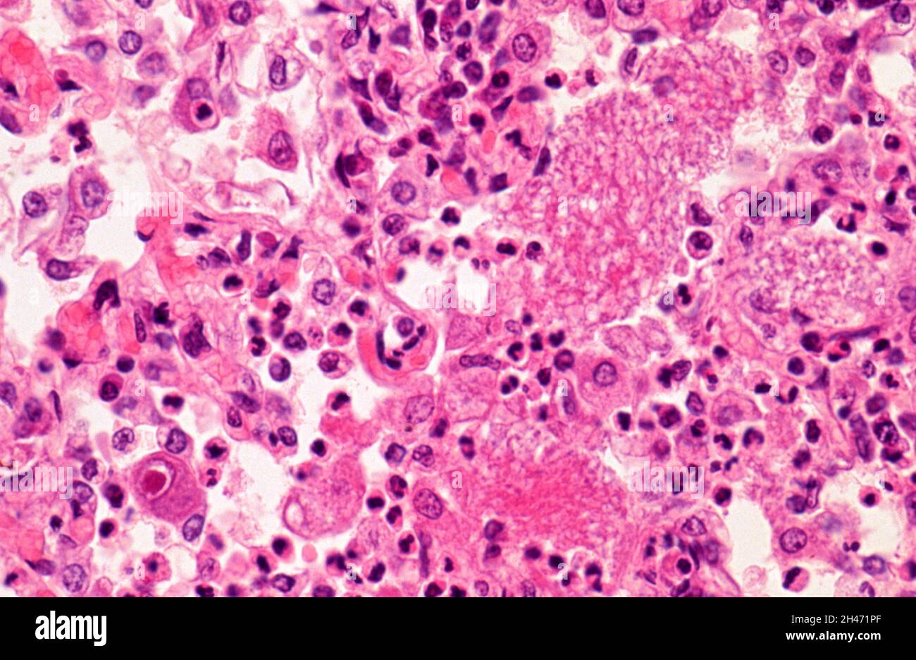 Lung: Pneumocystis carinii pneumonia (PCP) with HIV Stock Photo - Alamy