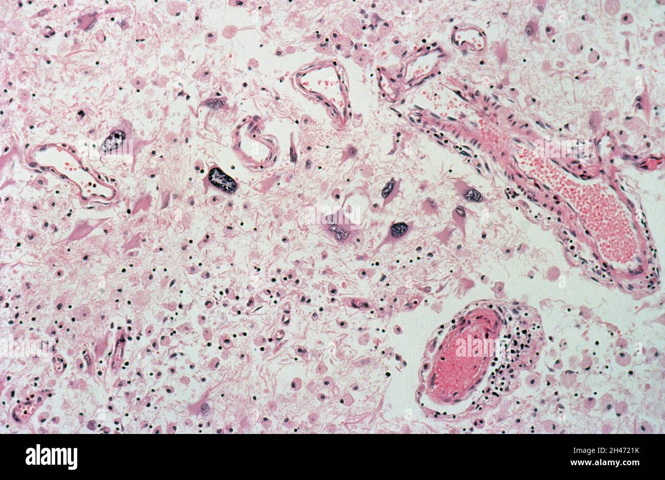 Progressive Multifocal Leukoencephalopathy Histology