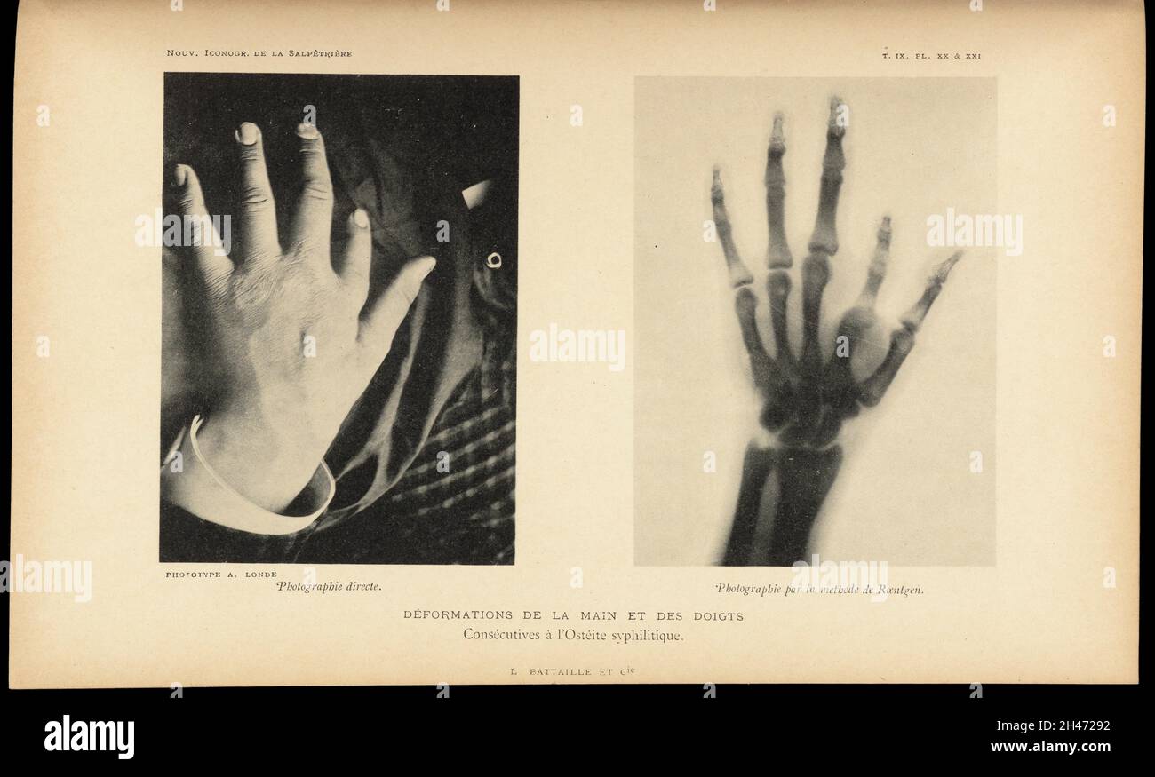 Photograph showing deformity of the hand and fingers Stock Photo - Alamy