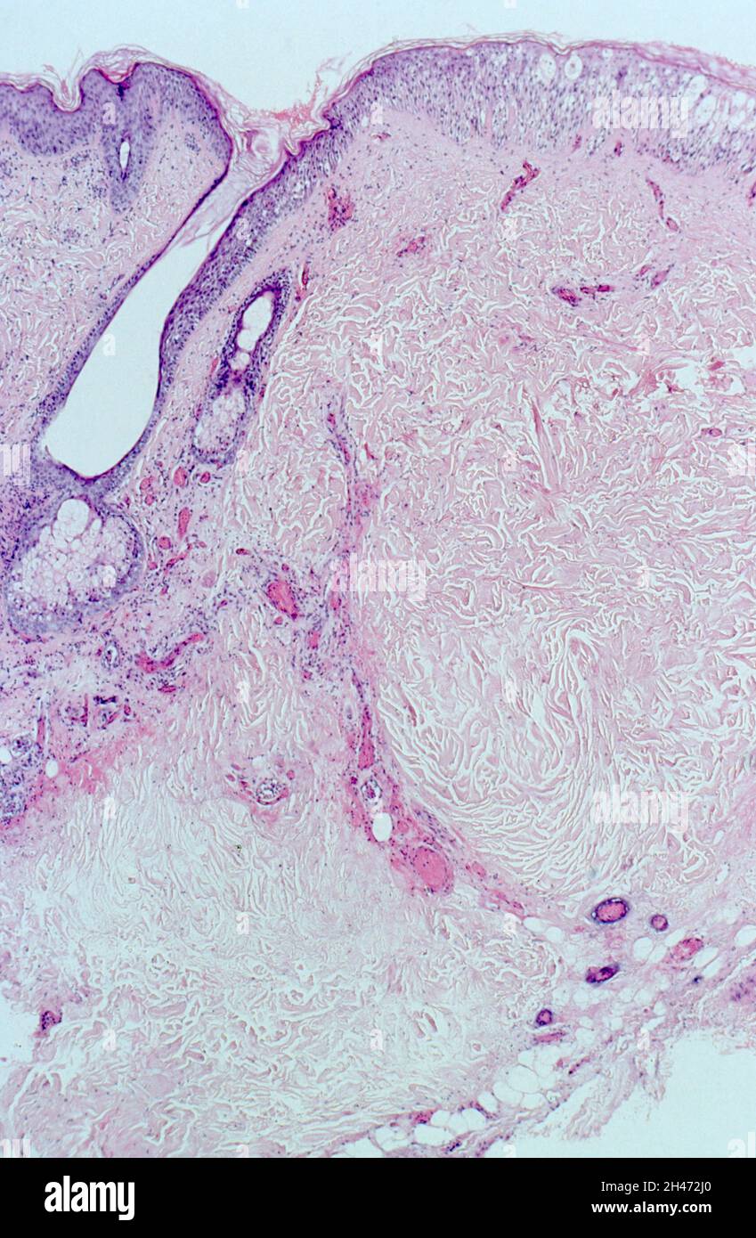 Skin: Pseudomonas aeruginosa vasculitis Stock Photo - Alamy