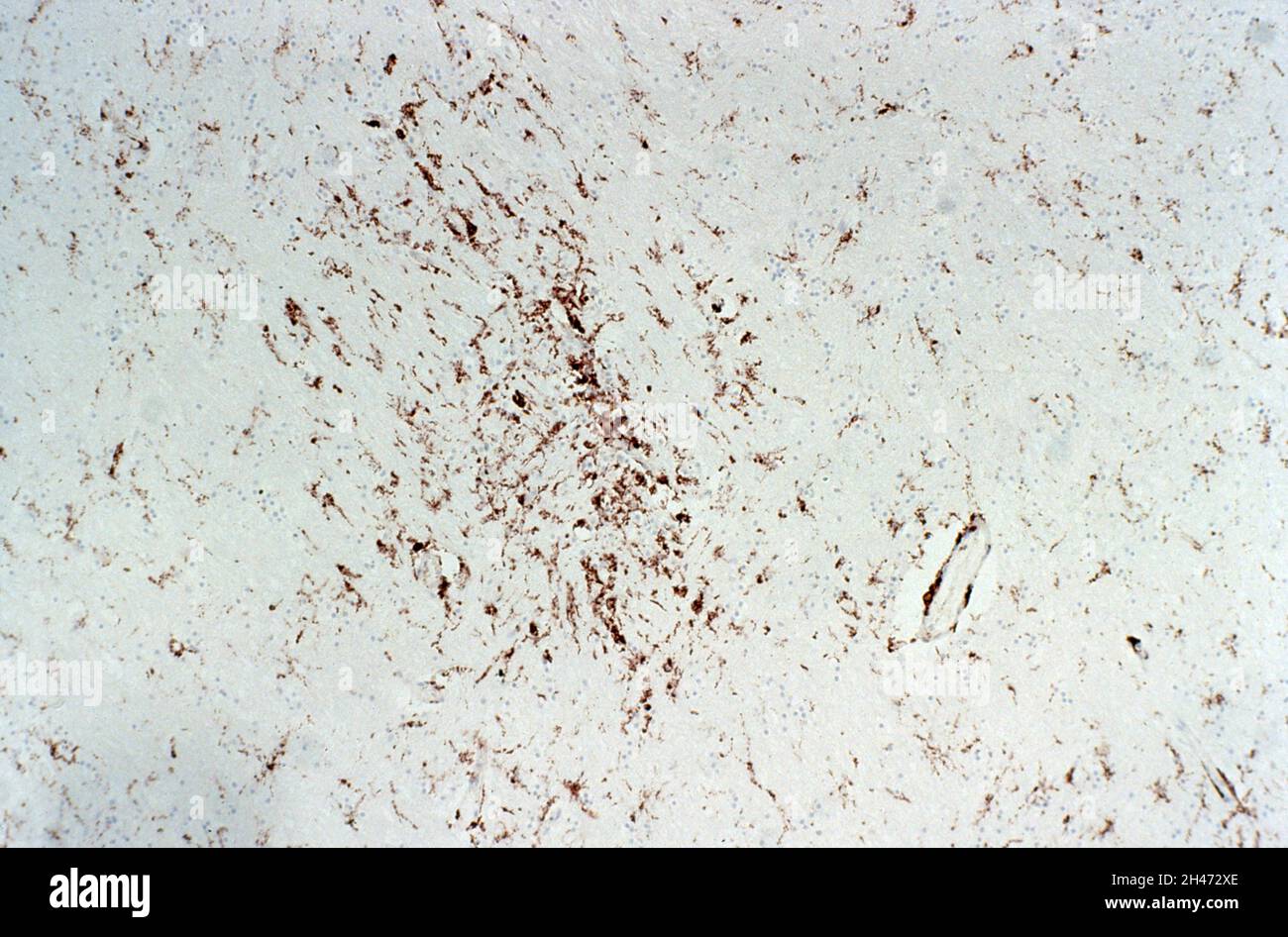 Brain: HIV encephalopathy Stock Photo - Alamy