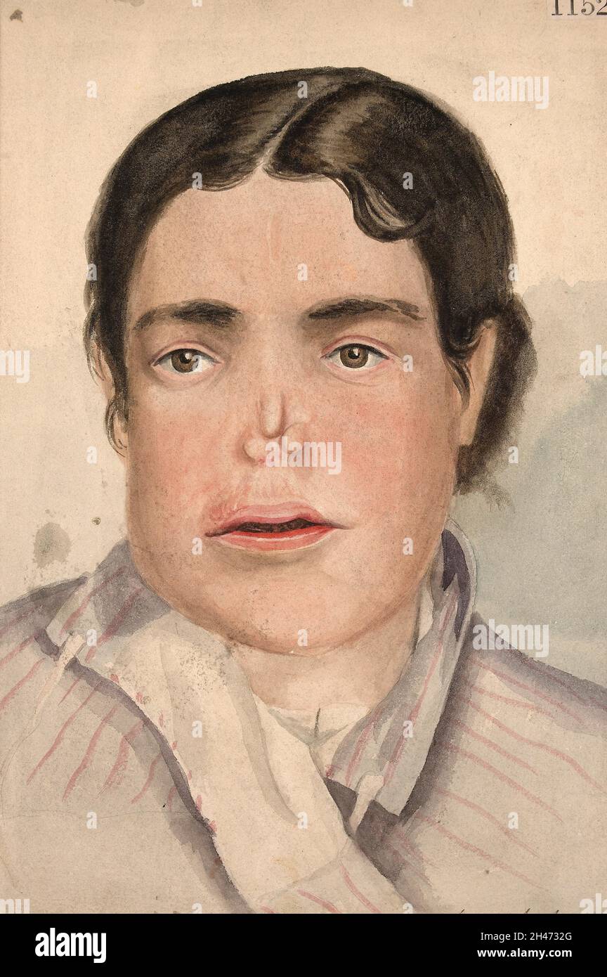 Face of a woman with destruction of the nose due to tertiary syphilis ...