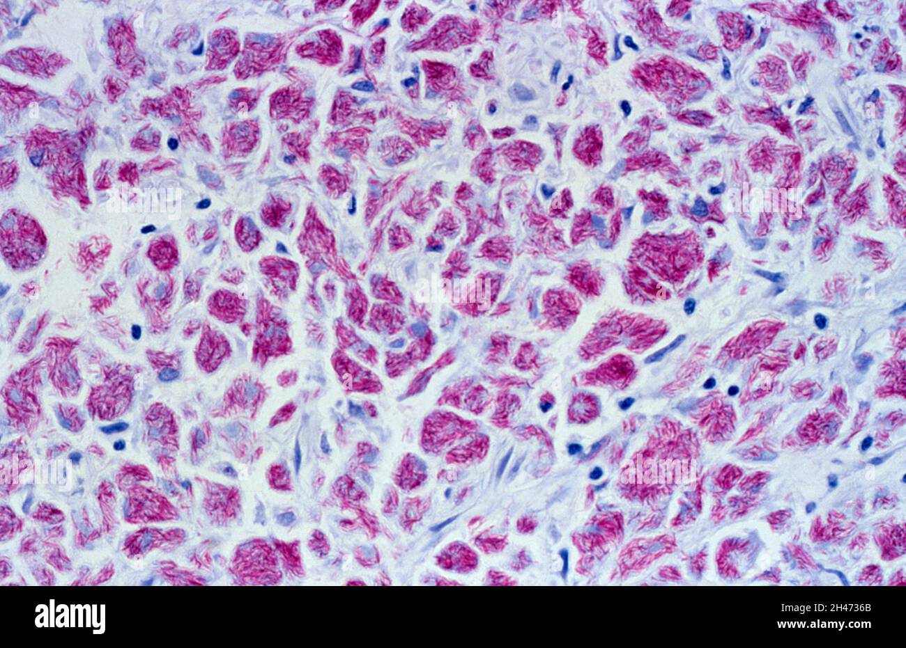 Mycobacterium Avium Primary Cutaneous Mycobacterium Avium Complex