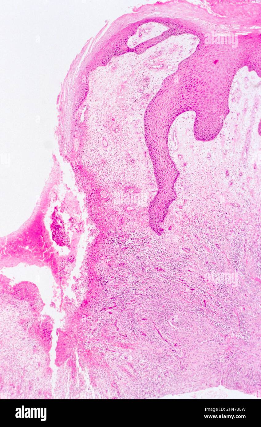 Skin: cutaneous amoebiasis Stock Photo - Alamy