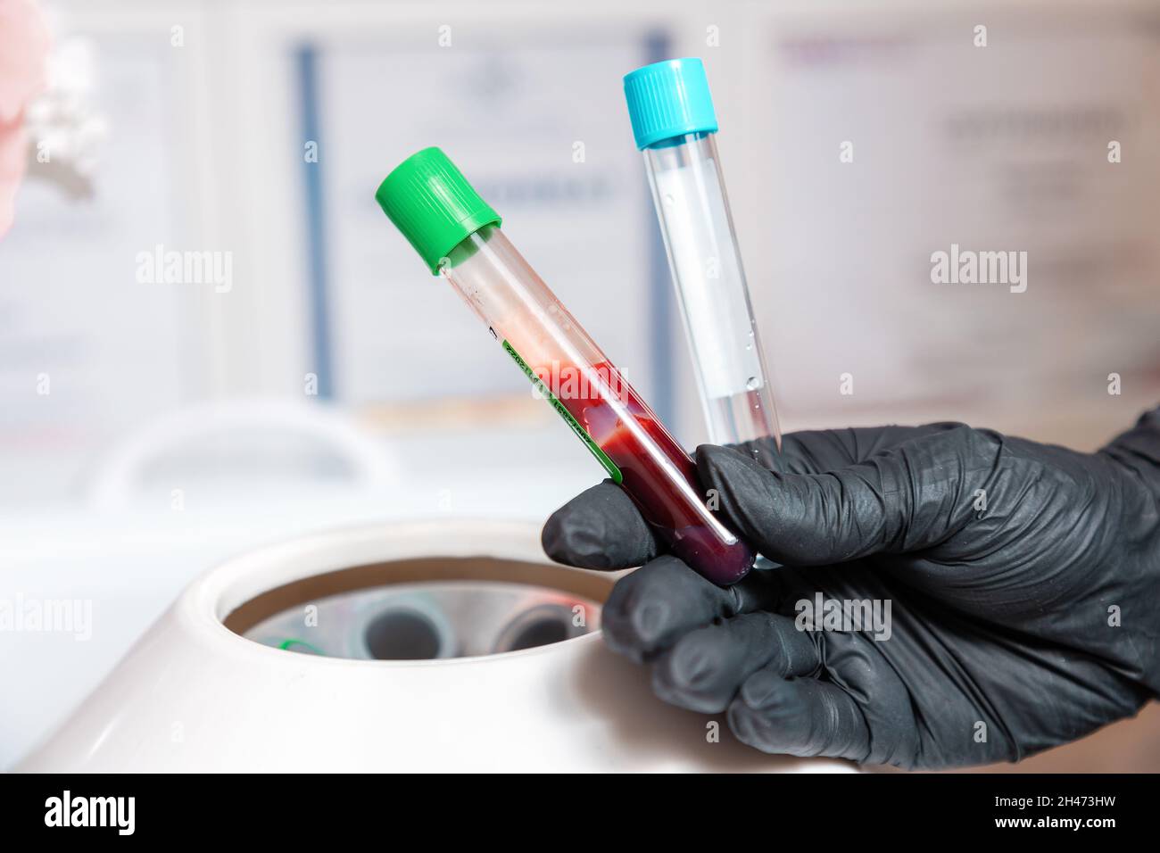 Plasmolifting. Preparation of blood for beauty injections ...