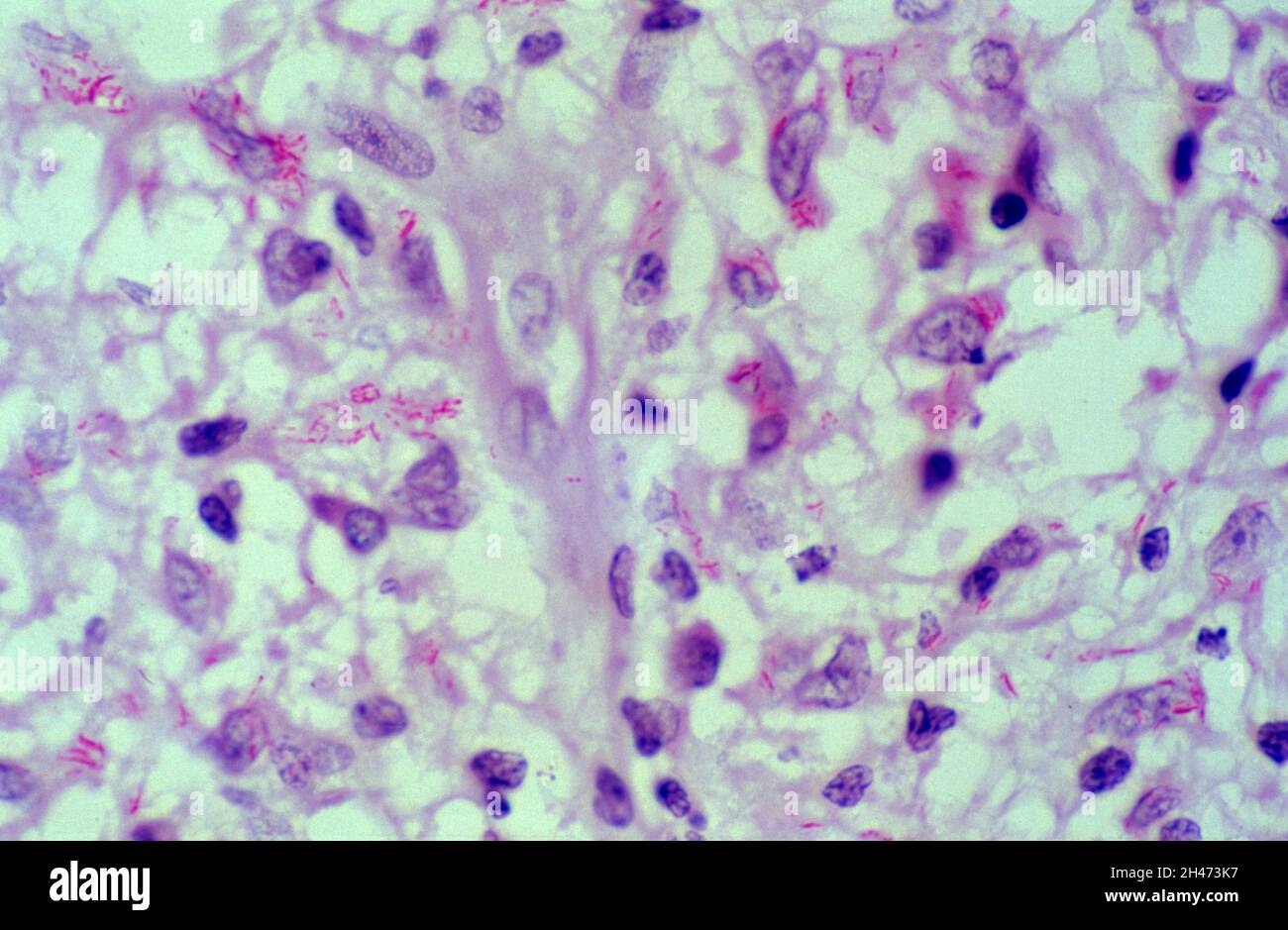 Leprosy: skin section Stock Photo - Alamy