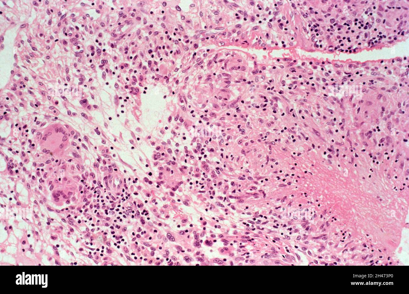 Leprosy: type 1 (reversal) leprosy reaction Stock Photo - Alamy