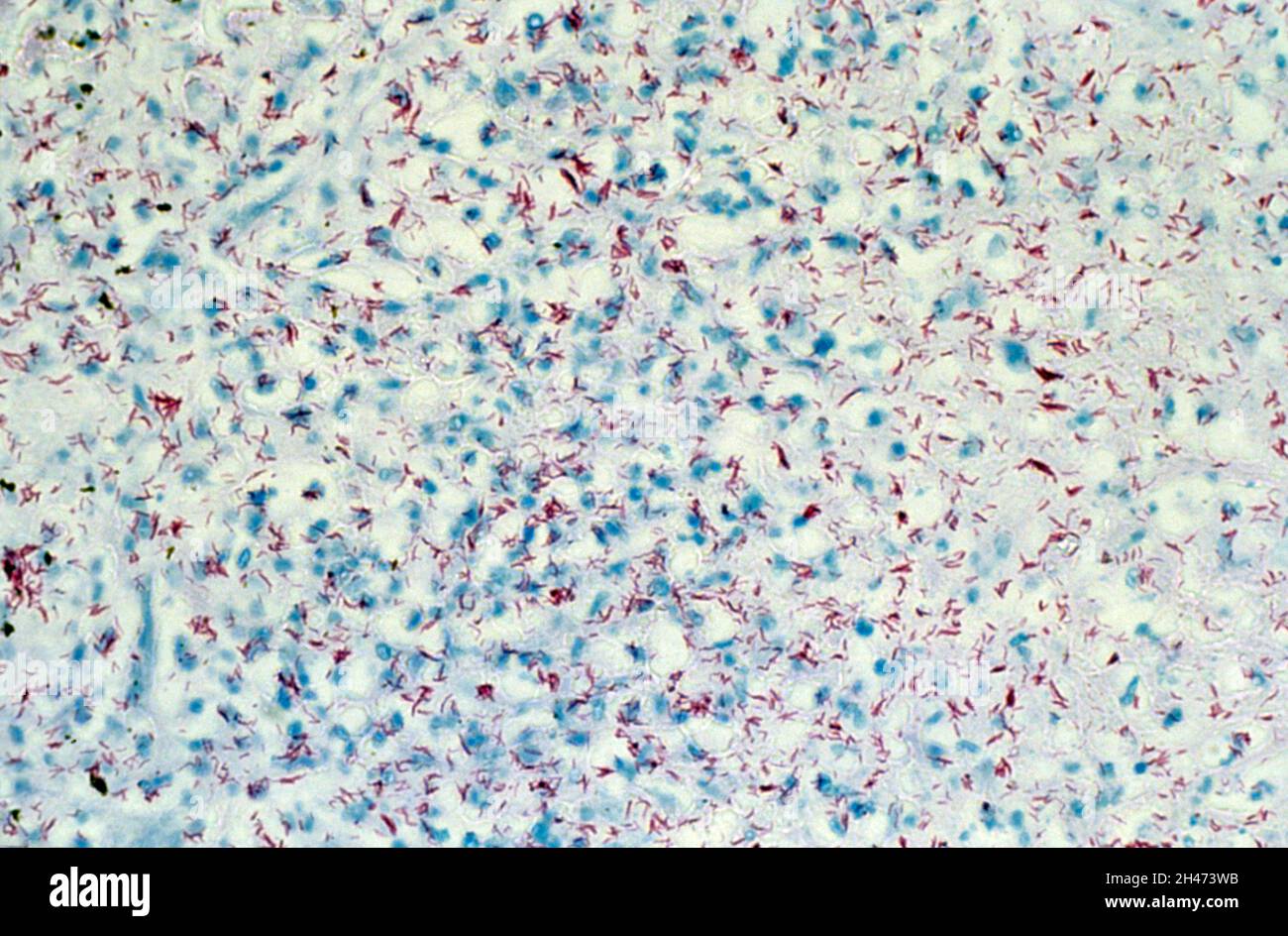 Miliary tuberculosis hi-res stock photography and images - Alamy
