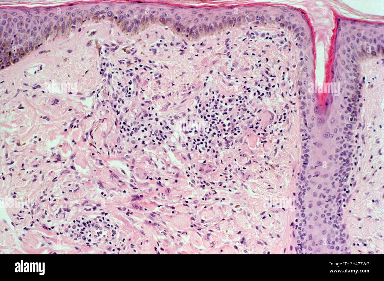Leprosy: type 1 (reversal) leprosy reaction Stock Photo - Alamy