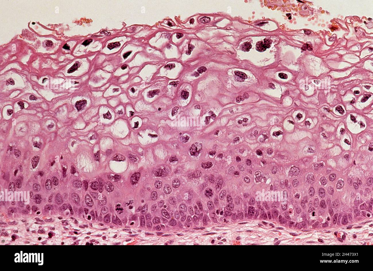 Cervix: human papillomavirus infection Stock Photo - Alamy