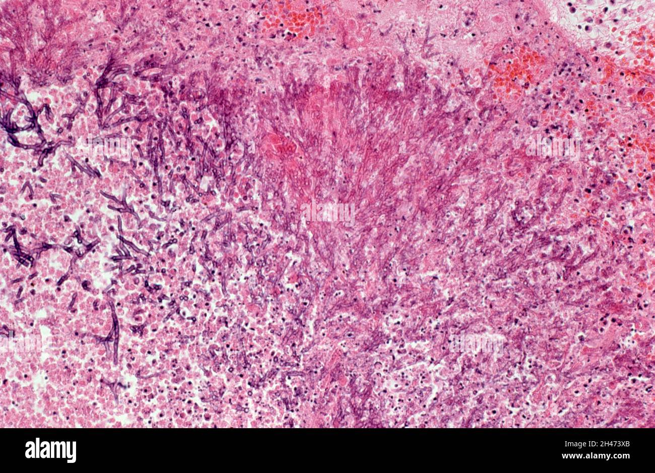 Lung: invasive pulmonary aspergillosis with AIDS Stock Photo - Alamy