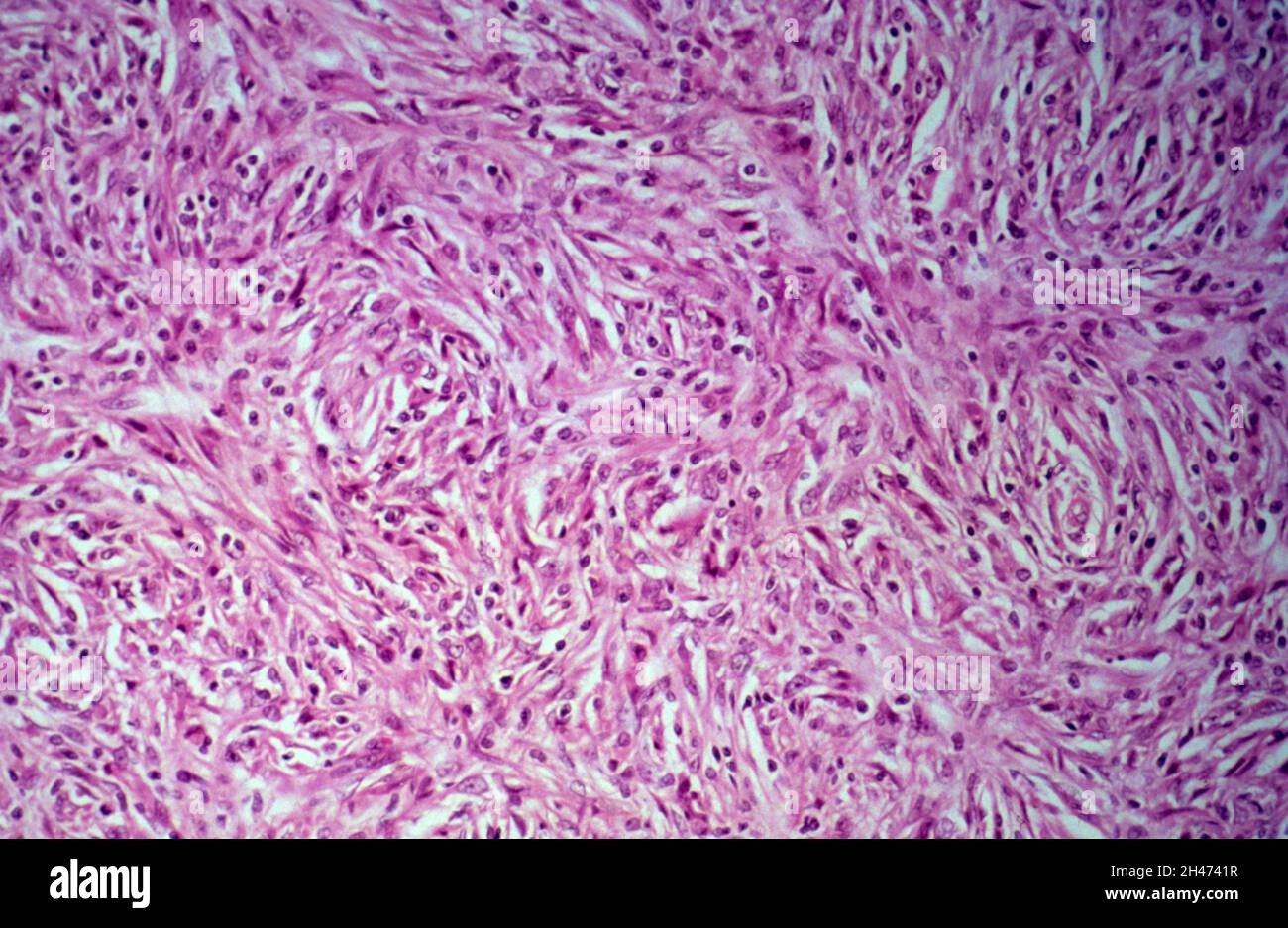 Lepromatous leprosy: histoid leprosy Stock Photo - Alamy