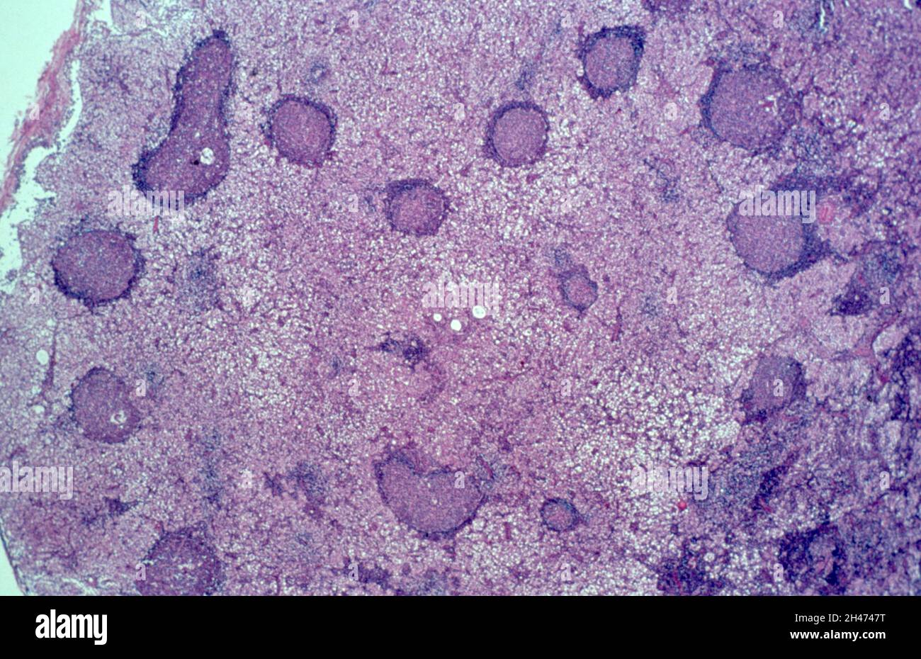 Lepromatous leprosy: lymph node Stock Photo - Alamy