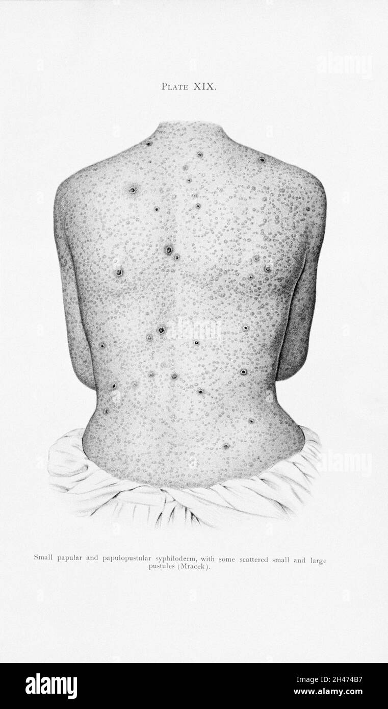 The back of a man suffering from syphilis, showing a rash of papular ...