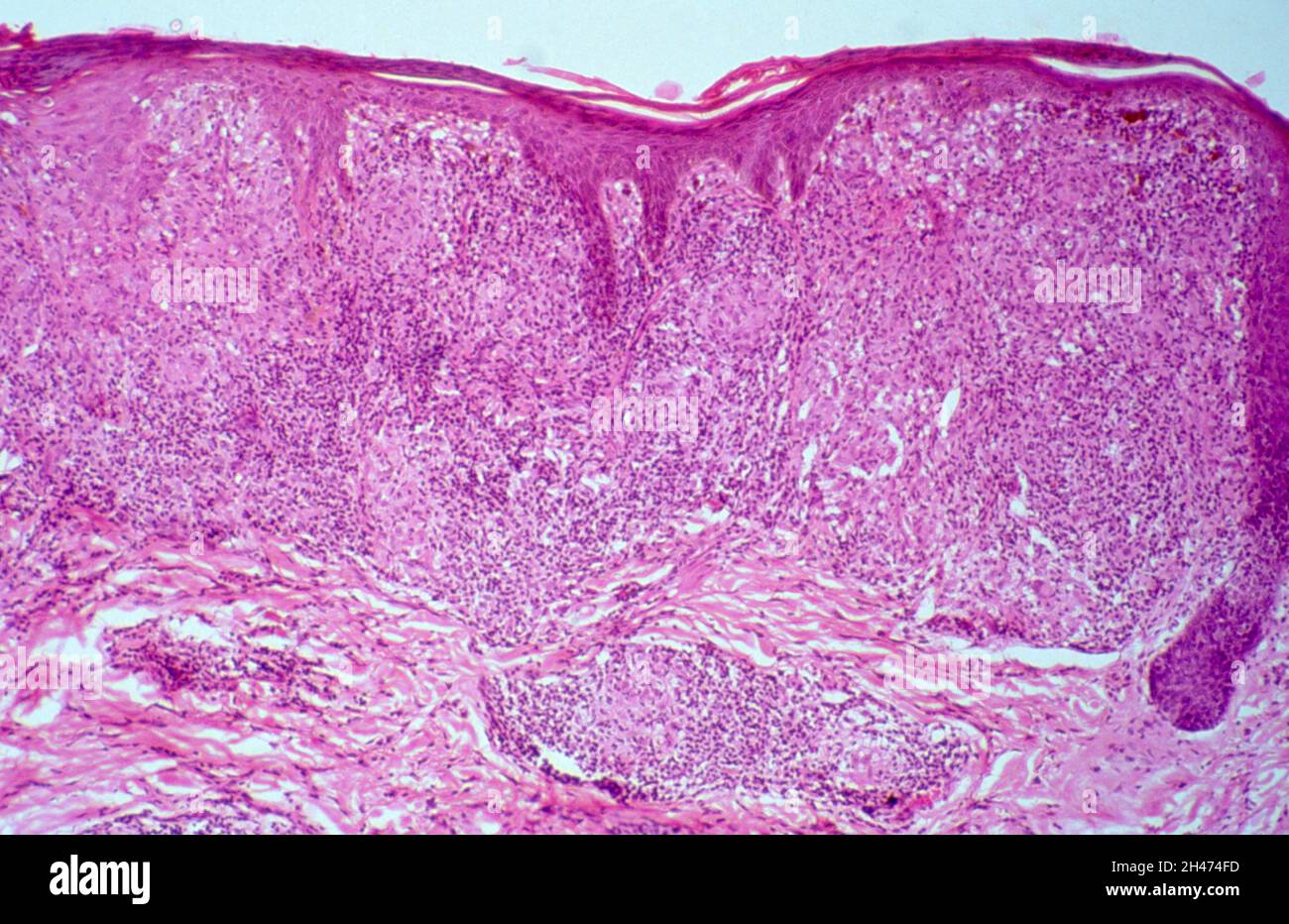 Leprosy: type 1 (reversal) leprosy reaction Stock Photo - Alamy