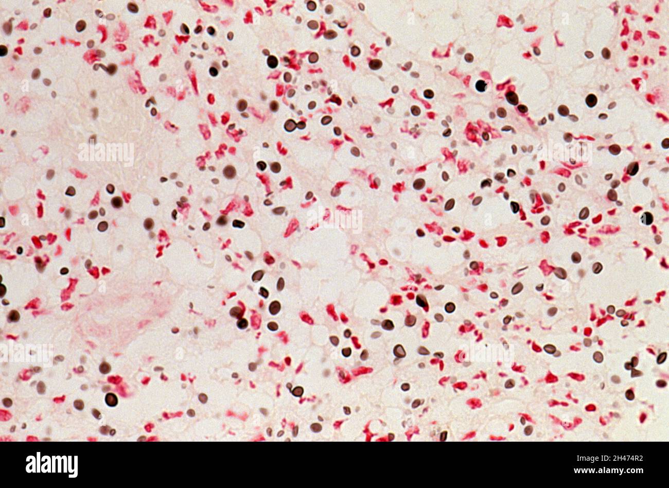 Skin: cryptococcosis with AIDS Stock Photo - Alamy