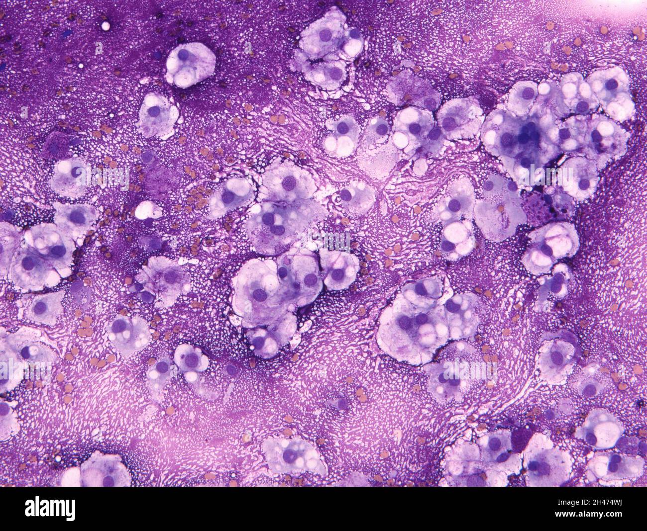 MGG stained smear of a C2 vertebral chordomal mass Stock Photo - Alamy