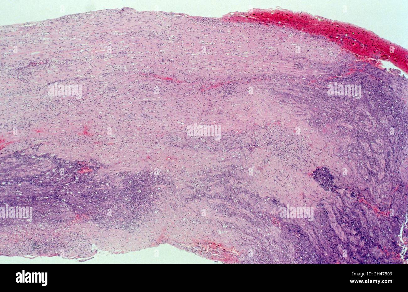 Lepromatous leprosy: type 2 ENL reaction Stock Photo - Alamy