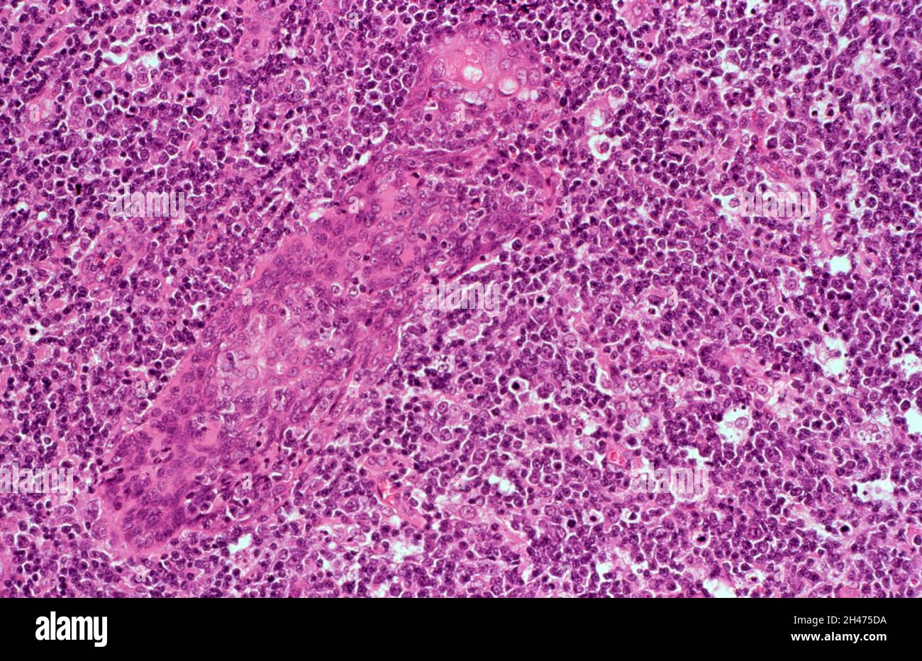 Parotid gland: lymphoepithelial cyst with HIV Stock Photo - Alamy