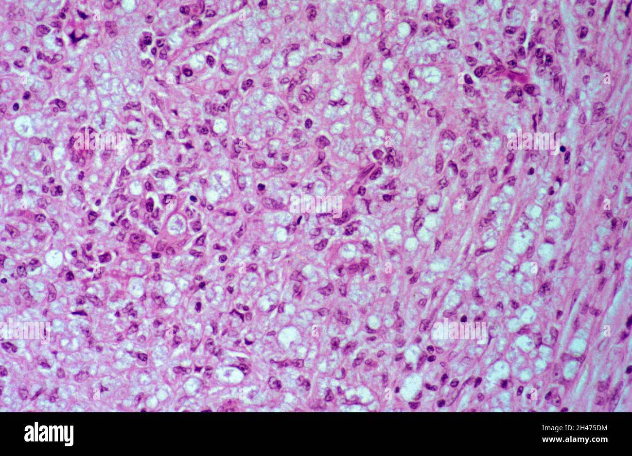 Leprosy: skin section Stock Photo - Alamy