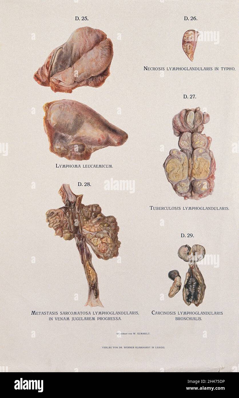 Dissections of diseased lymph glands : six figures. Chromolithograph by ...