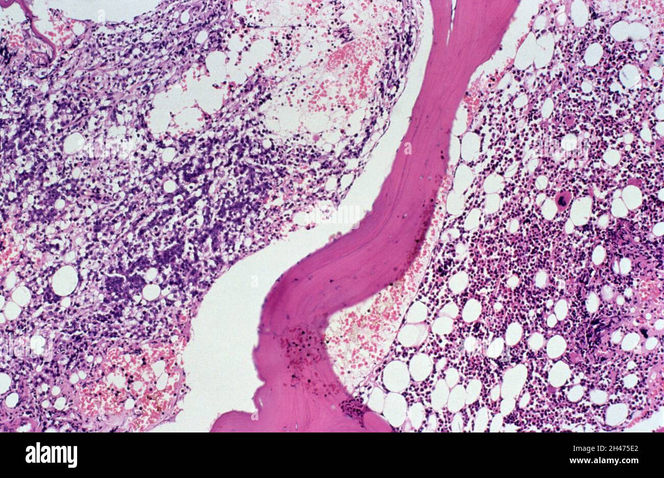 Non-Hodgkin's lymphoma with AIDS: bone marrow Stock Photo - Alamy