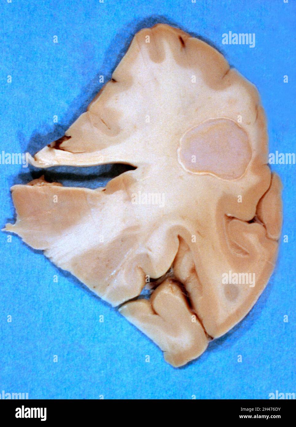 Brain: cerebral toxoplasmosis Stock Photo - Alamy