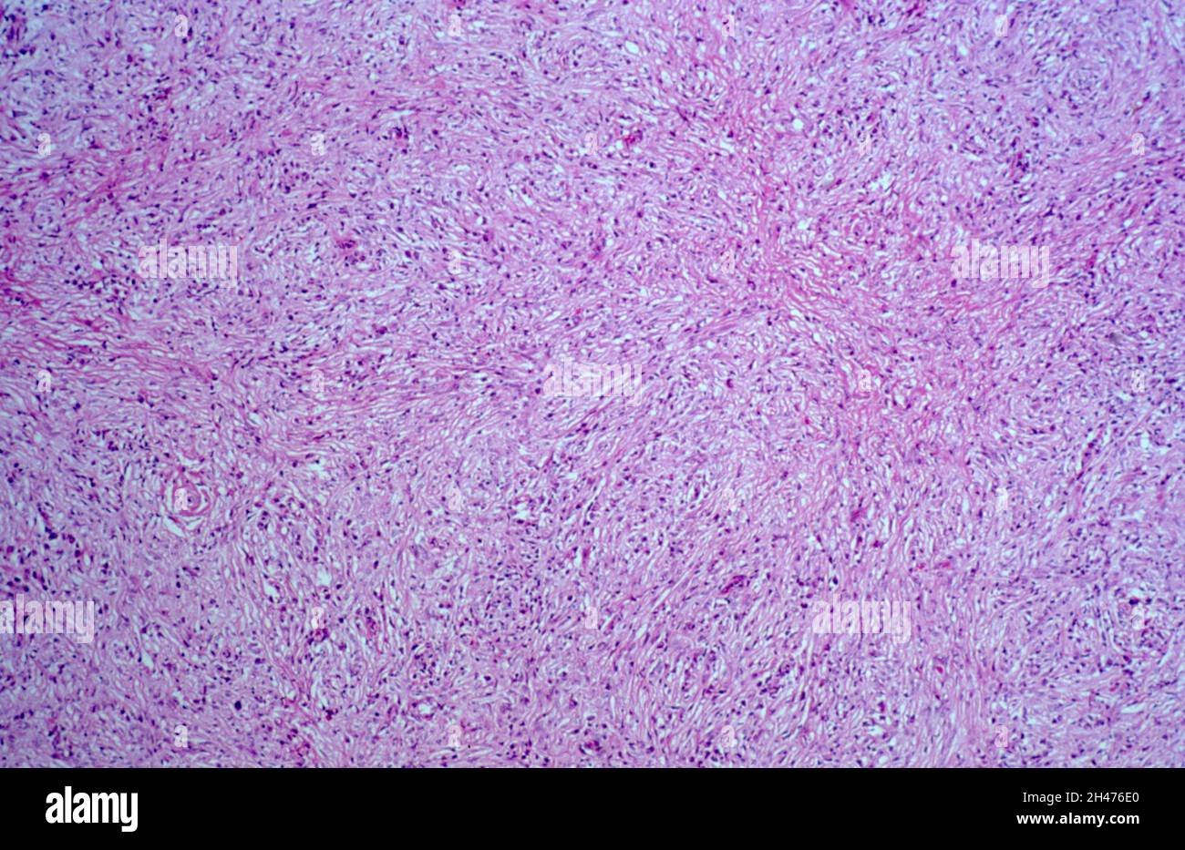 Lepromatous leprosy: histoid leprosy Stock Photo - Alamy