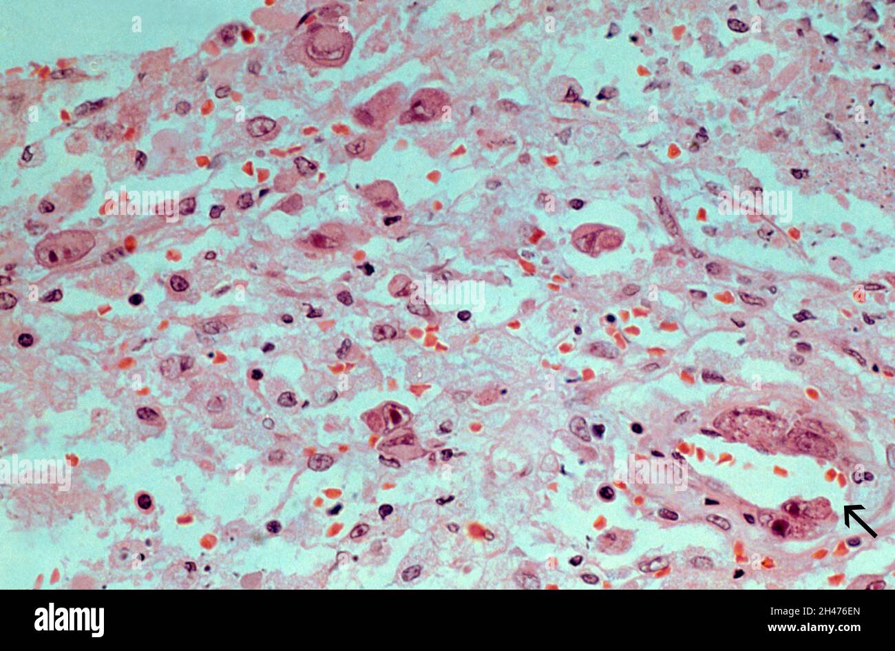 Brain: cytomegalovirus (CMV) infection with HIV Stock Photo - Alamy