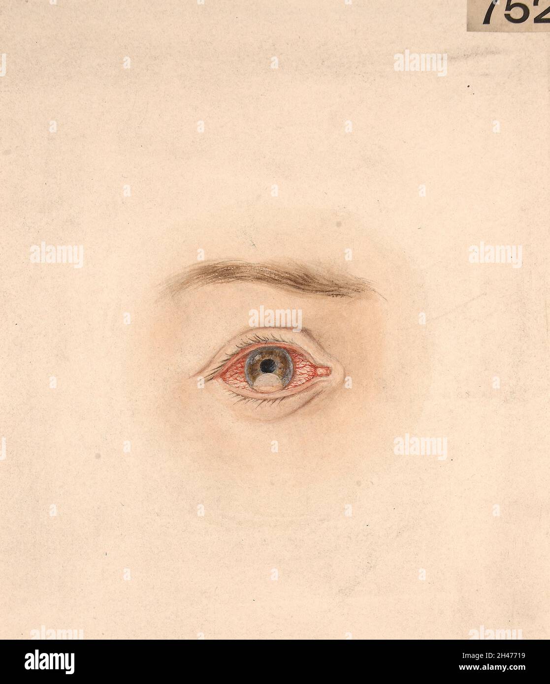 Eye showing a dislocation of the lens into the anterior chamber Stock ...