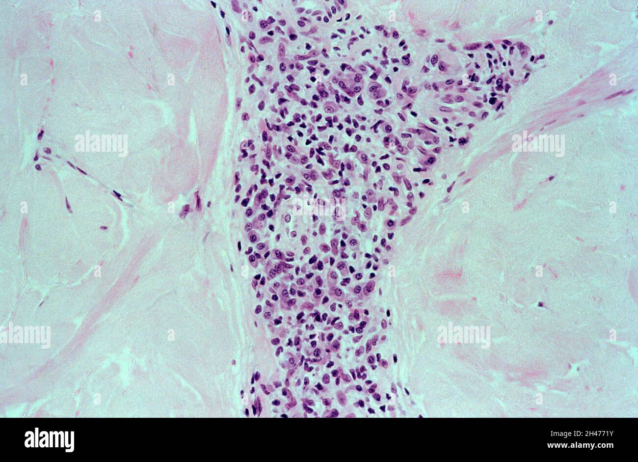 Leprosy: borderline tuberculoid leprosy, skin Stock Photo - Alamy