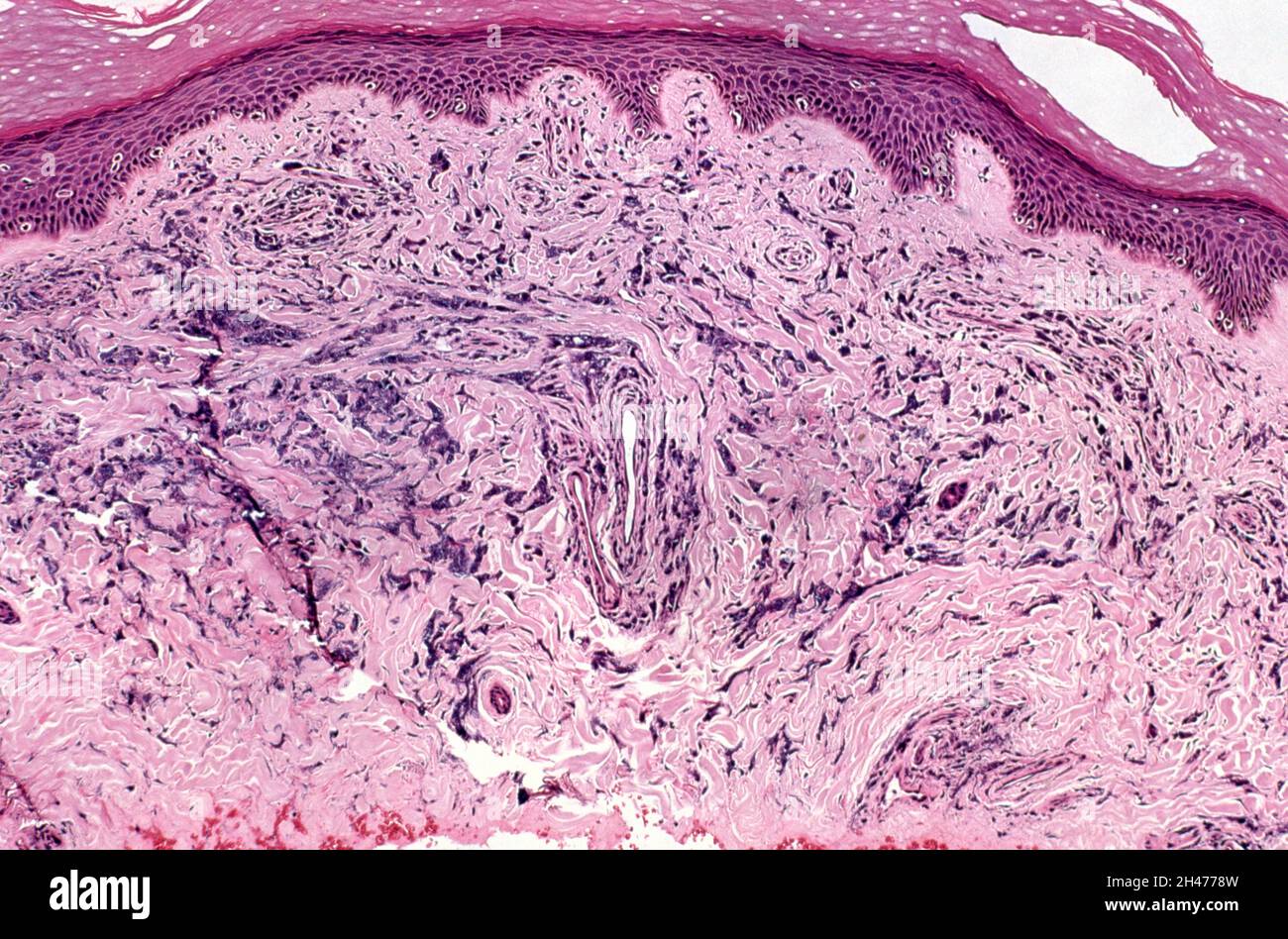 Skin: leishmaniasis with AIDS Stock Photo - Alamy