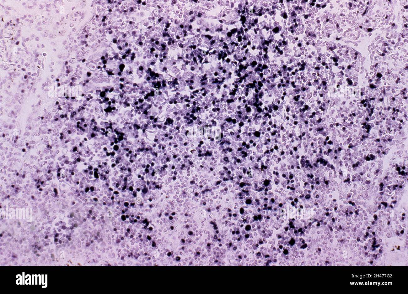 Lung: lymphocytic interstitial pneumonitis (LIP Stock Photo - Alamy