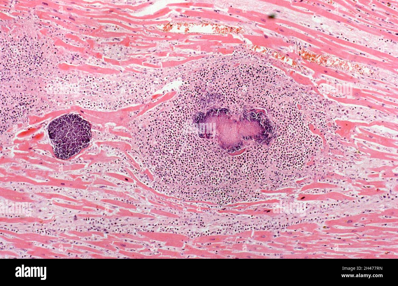 Staphylococcus aureus infection: cardiac abscess Stock Photo - Alamy