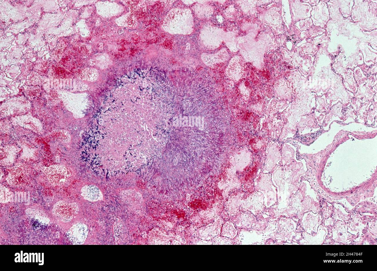 Lung: invasive pulmonary aspergillosis with AIDS Stock Photo - Alamy