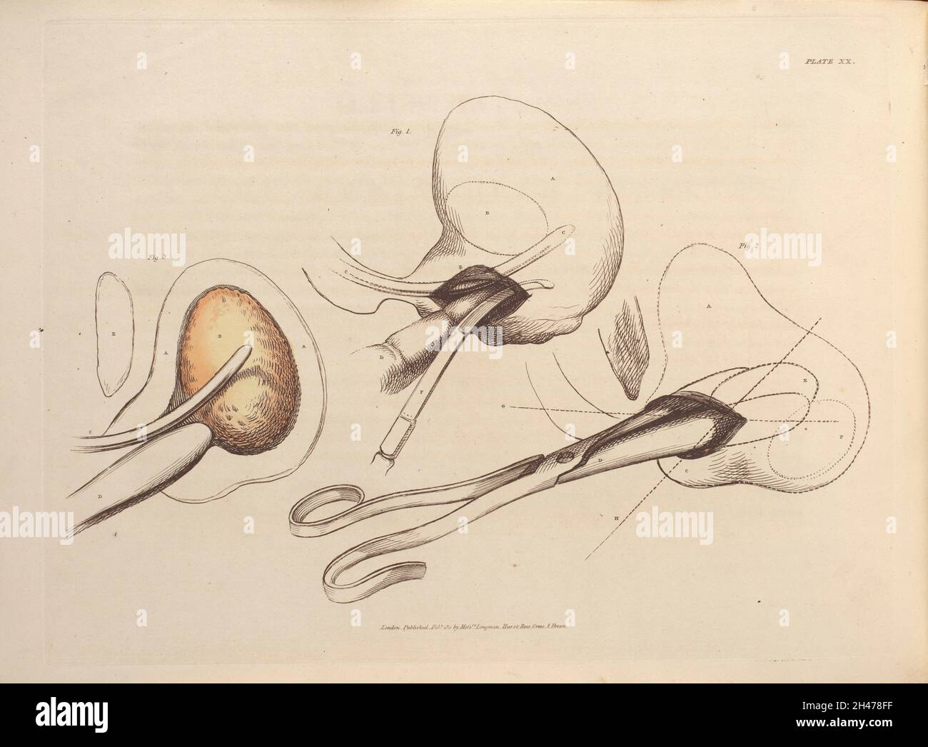 Removal of bladder stone hi-res stock photography and images - Alamy