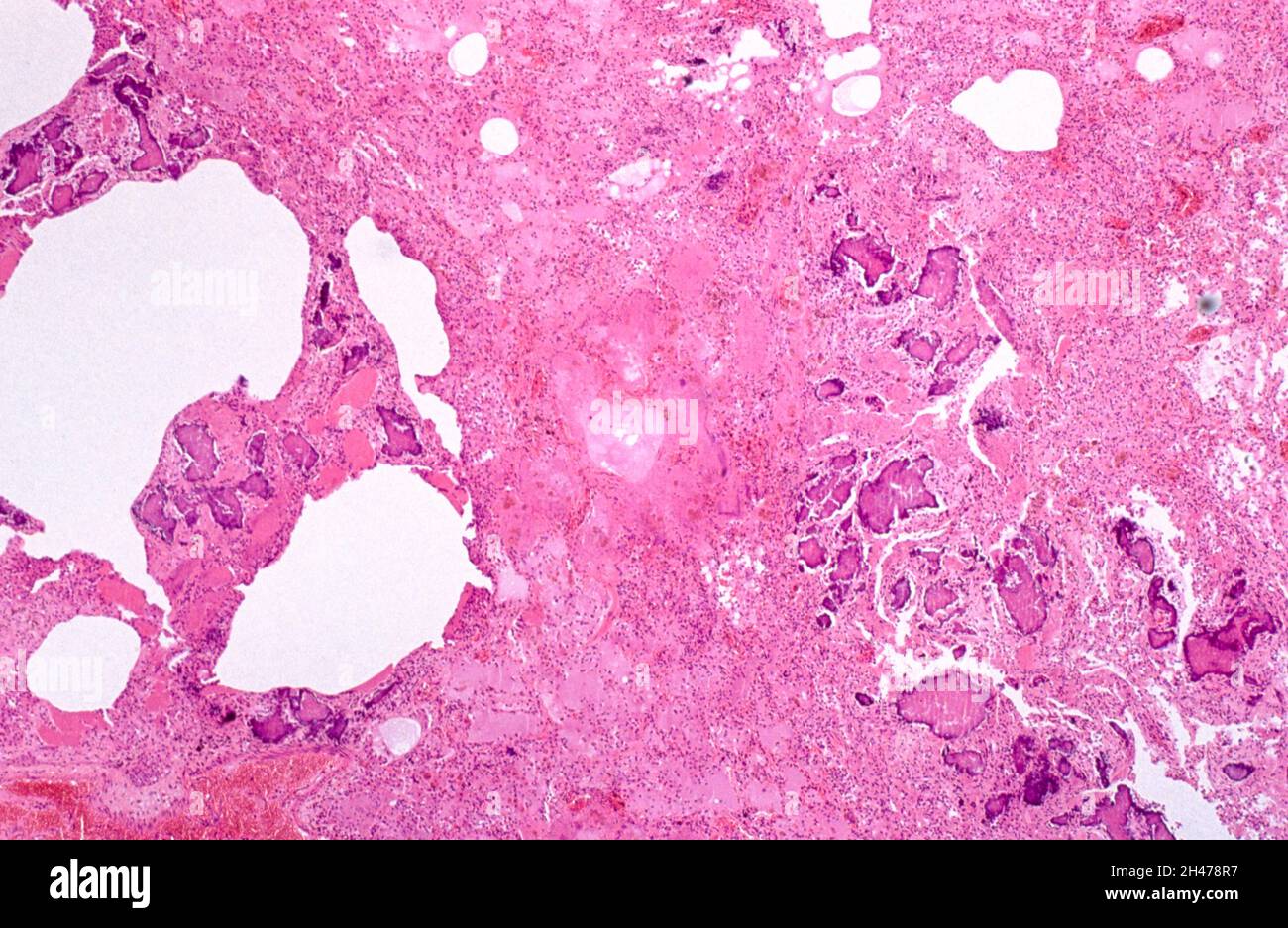 Lung: Pneumocystis carinii pneumonia (PCP Stock Photo - Alamy