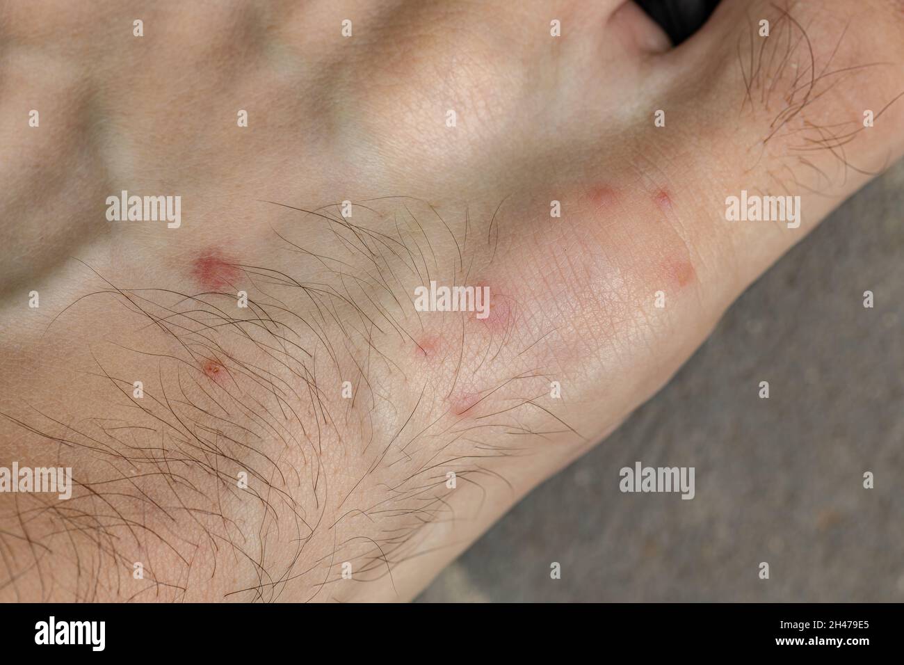 Human feet with various allergic reactions to tick bites with selective ...