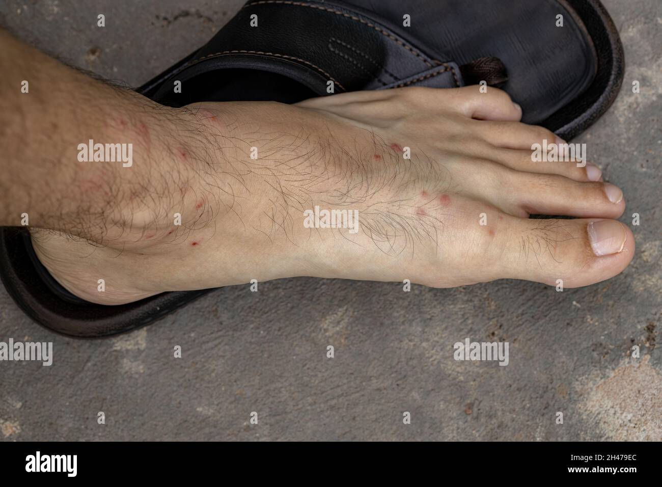 Human feet with various allergic reactions to tick bites with selective ...