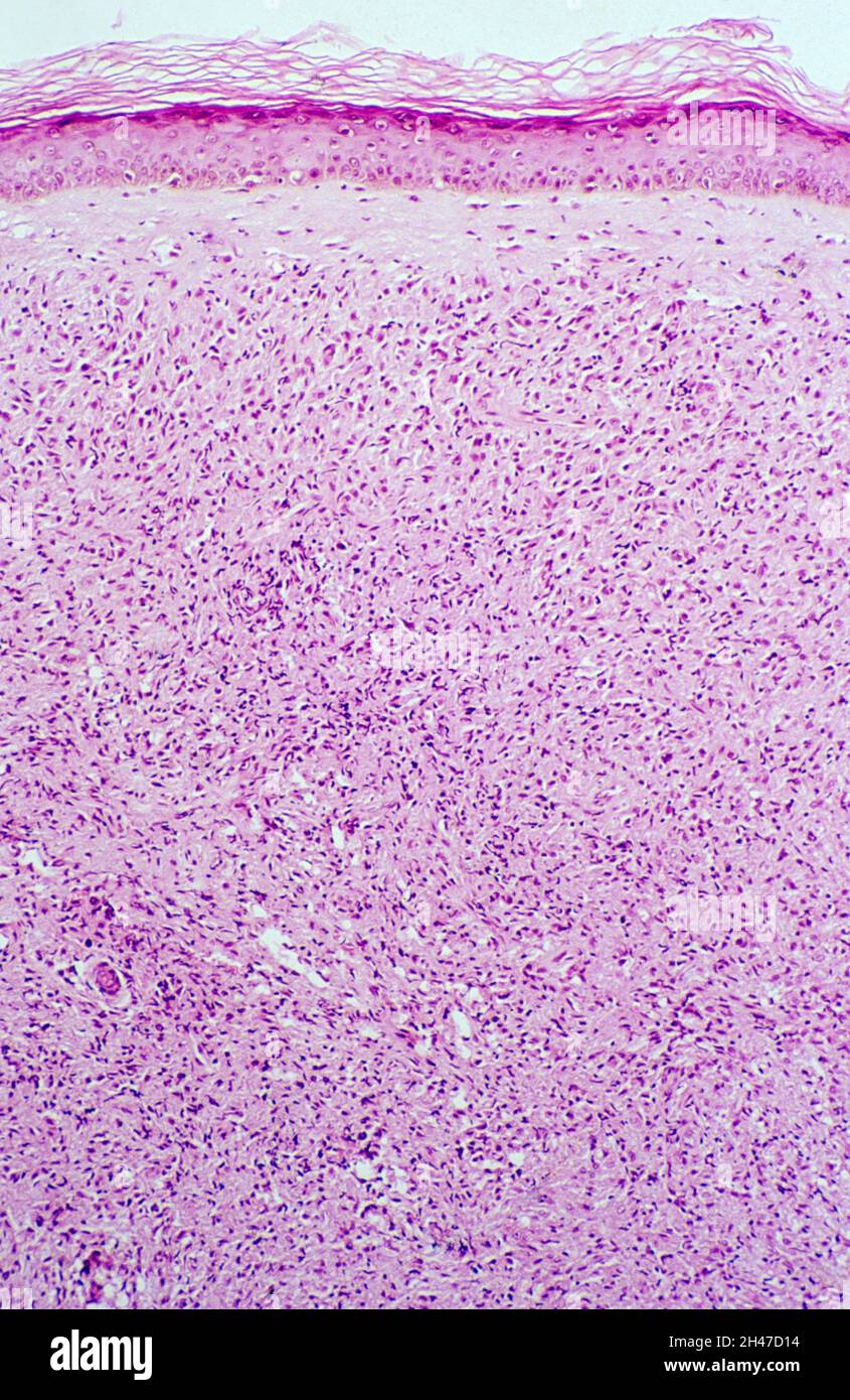 Leprosy: skin section Stock Photo - Alamy