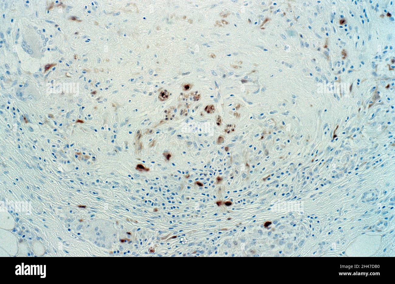 Leprosy: borderline tuberculoid leprosy, dermal nerve Stock Photo - Alamy