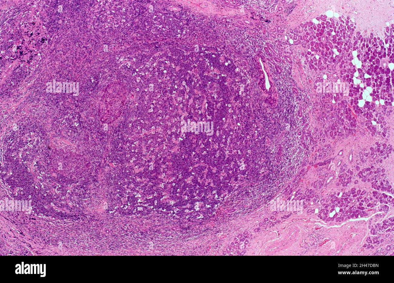 Salivary gland parotid hi-res stock photography and images - Alamy