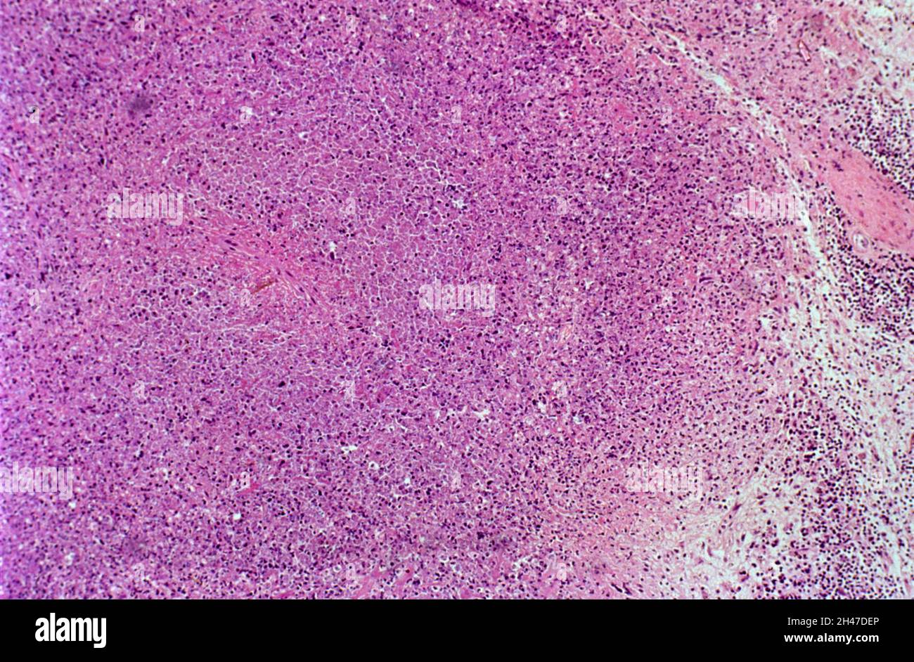 Miliary Tuberculosis Histology