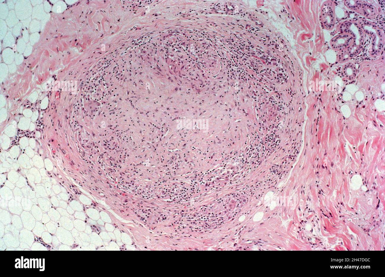 Leprosy: borderline tuberculoid leprosy: dermal nerve Stock Photo - Alamy