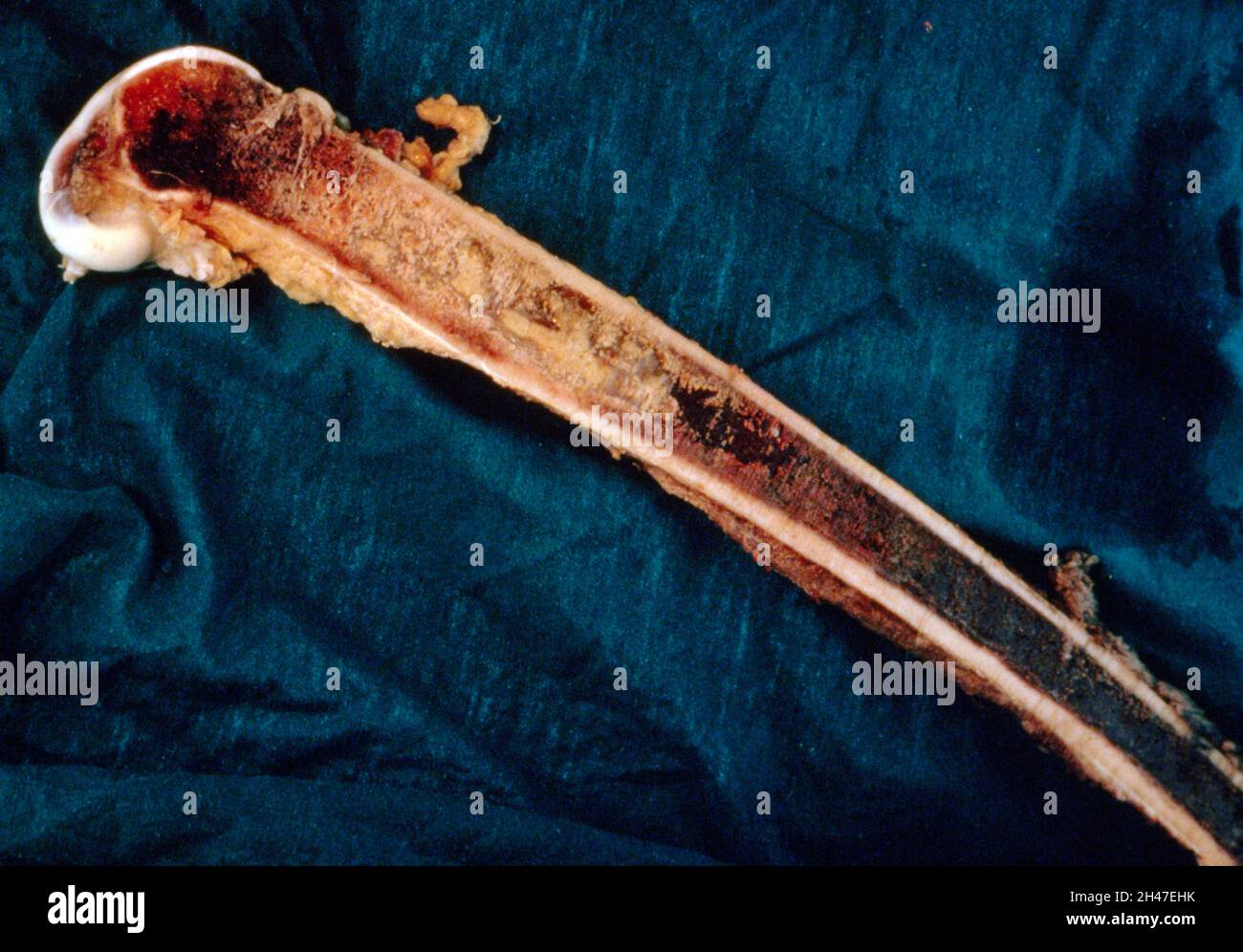 Sickle cell disease: bone marrow expansion Stock Photo - Alamy